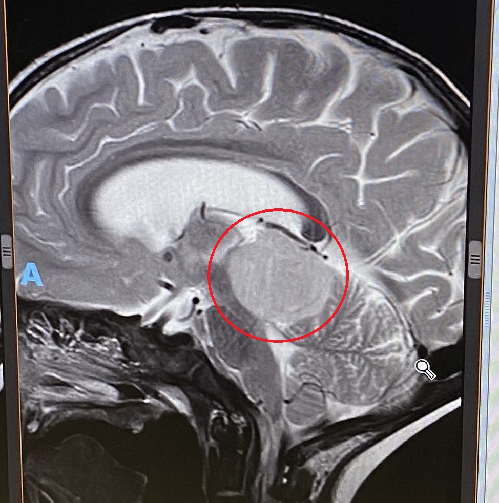 2 years on from Eloise’s major surgery – how has our perspective ...